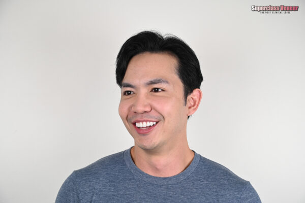 Superclass Veneer Gen4 - Mediclass